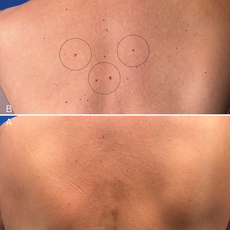 Laser Treatments in Bourbonnais | Ria Skin Care and Spa